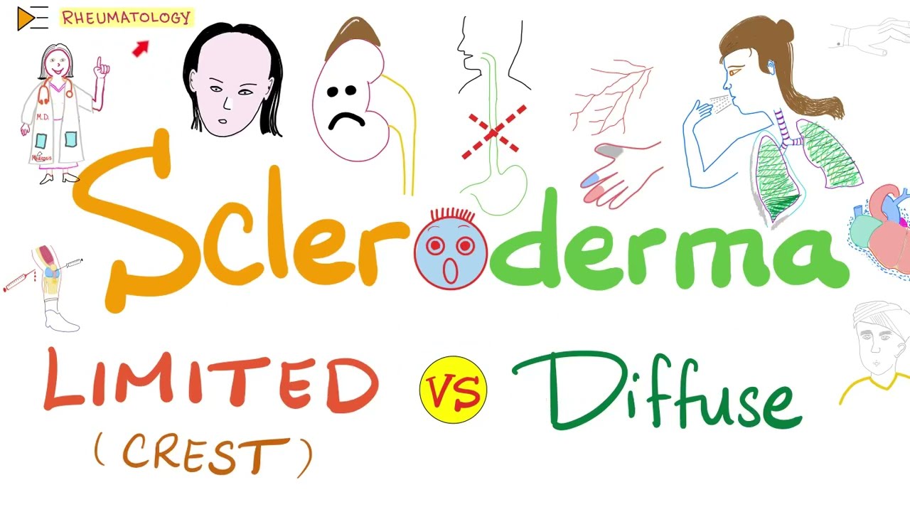 Limited Scleroderma (CREST) vs Diffuse Scleroderma | Rheumatology
