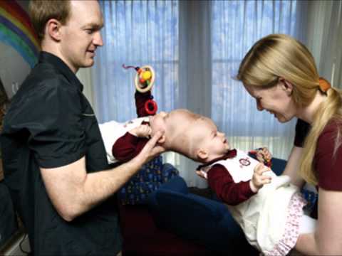 Glenn Beck on how Dr. Ben Carson was first to separate Siamese conjoined twins joined at head