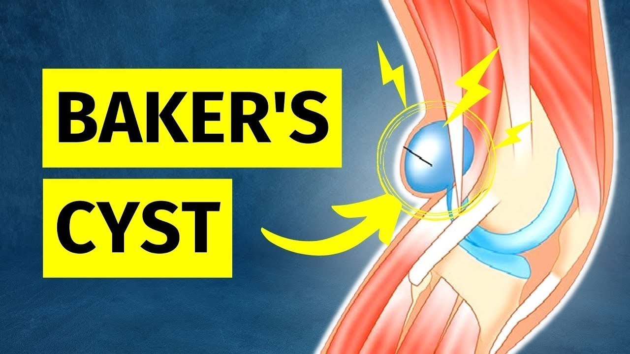 How to ACTUALLY Treat a Baker's Cyst (Pain Behind Knee)