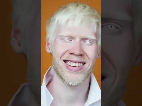 Ocular Albinism #shorts