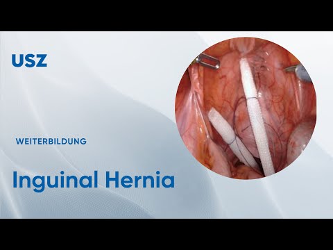 Inguinal Hernia – Please participate in our 3-minute survey below!