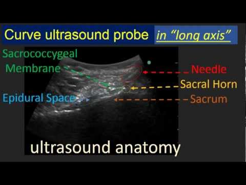 Infiltration épidurale échoguidée via le hiatus sacro-coccygien ...
