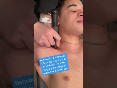 Baseball Pitcher Still Has Shoulder Pain After Labrum Tear Surgery (TIl he got treated with THIS)