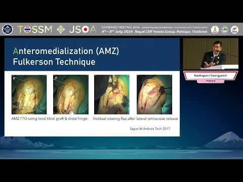 Update in PF surgery