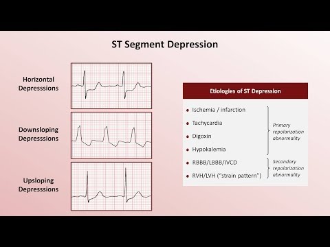 Intro to EKG Interpretation - QRST Changes