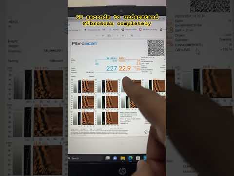 Easiest method (60 seconds) to understand Fibroscan report.