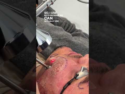 The MOST Effective Acne Scar Treatment in 2023!