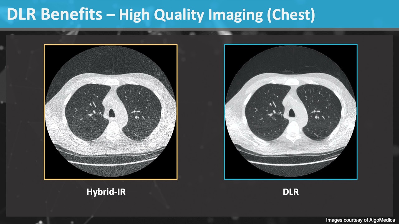 Increase Productivity and Clinical Decision Support through Deep Learning CT Image Processing