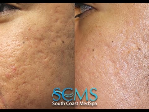 LA Before and After Acne Scar Removal!