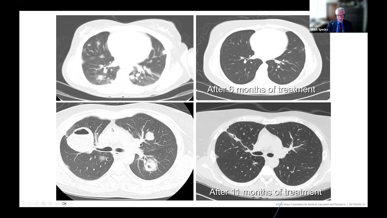 Pulmonary Issues and Vasculitis_Pulmonary Imaging 2023