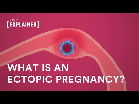What is an ectopic pregnancy?