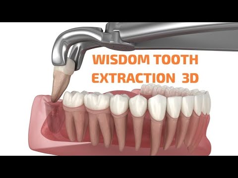 WISDOM TOOTH EXTRACTION | STEP BY STEP | MEDICAL 3D ANIMATION | #eduquest #elearning #learnonline