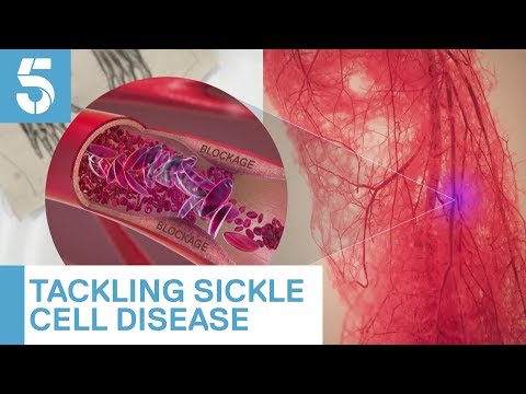 Sickle cell: Low awareness prompts new blood donor campaign | 5 News