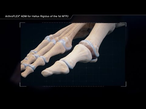 ArthroFLEX® ADM for Hallux Rigidus of the 1st MTPJ