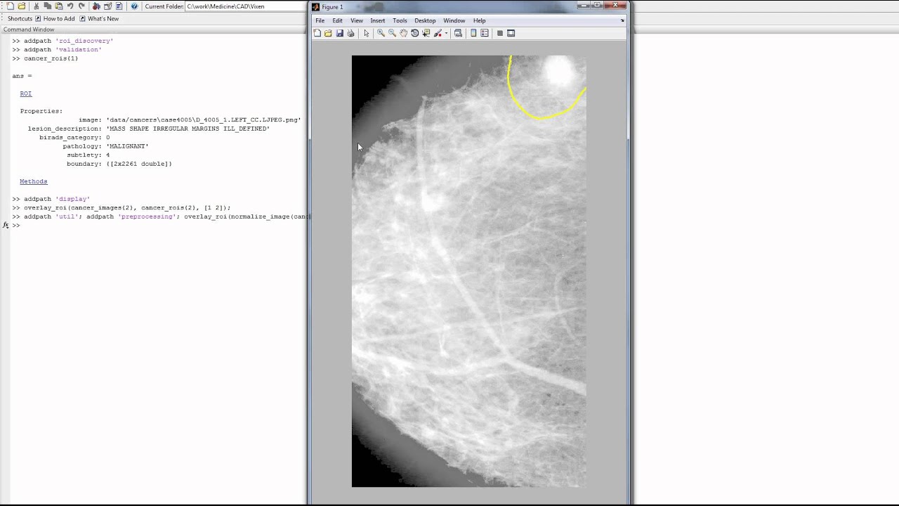 Digital Mammographer: computer detects breast cancer