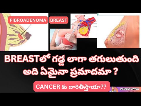 BREAST LUMP # FIBROADENOMA OF BREAST # AWARENESS