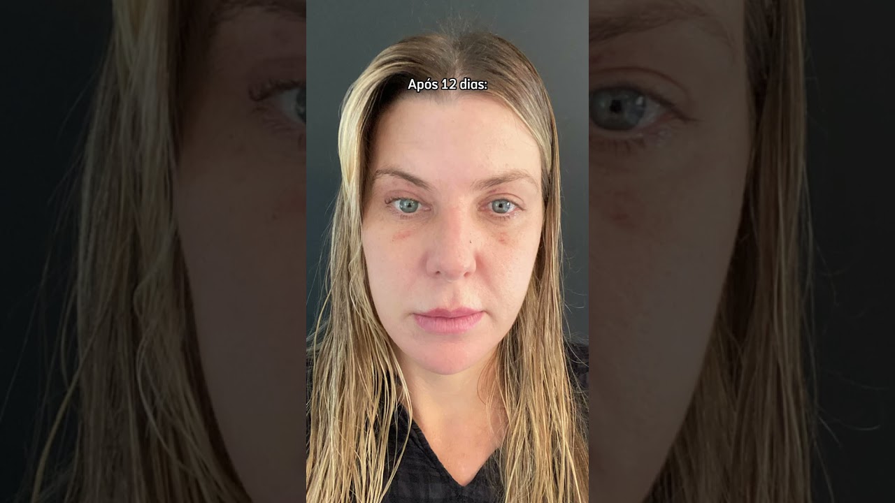 BEFORE AND AFTER BLEPHAROPLASTY: