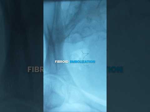 Shrink fibroids. Save your uterus. 💉✨#ufe #painrelief #uterinefibroidembolization
