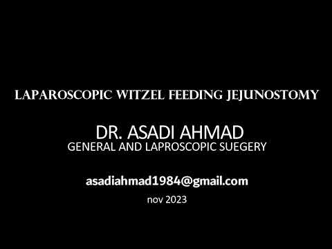 laparoscopic vezel feeding jejunostomy by dr asadi
