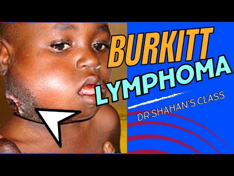 Burkitt Lymphoma | FMGE NEETPG INICET exams