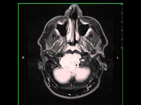 Chordoma