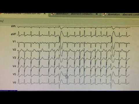 Wide QRS at physiological conditions