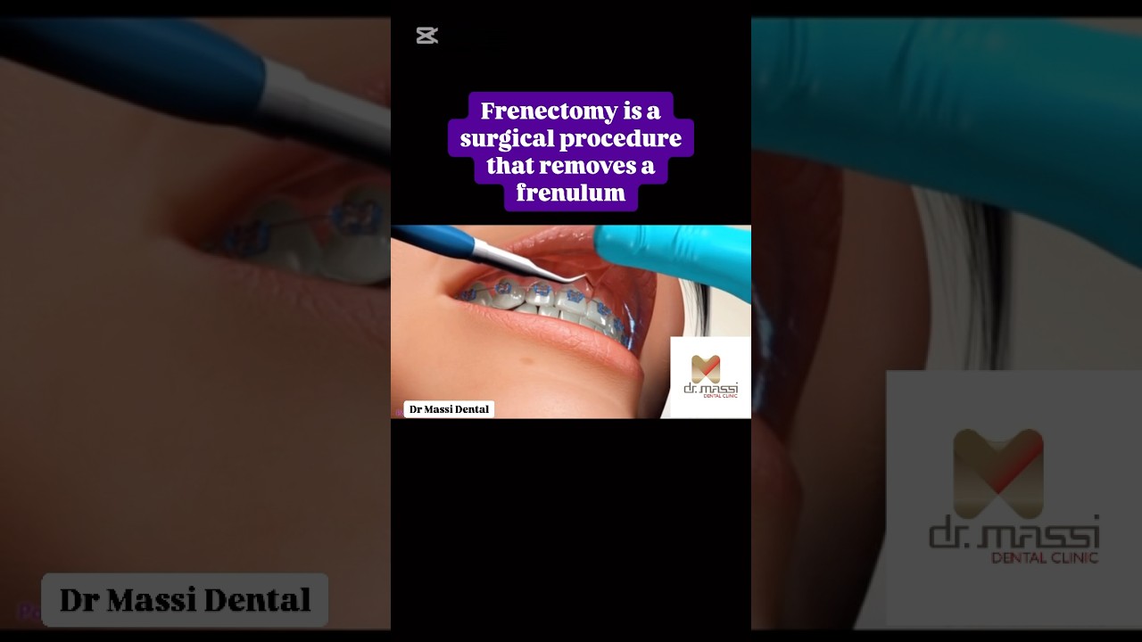 Frenectomy