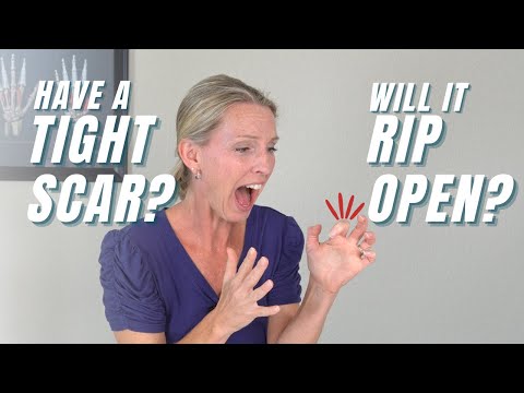 Is Tight Scar Tissue Limiting Movement of Your Hand or Finger? Get 3 Tight Scar Tissue Treatments