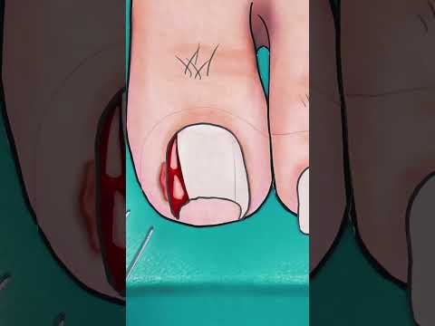 Ingrown Toenail Removal: A Guide to the Procedure