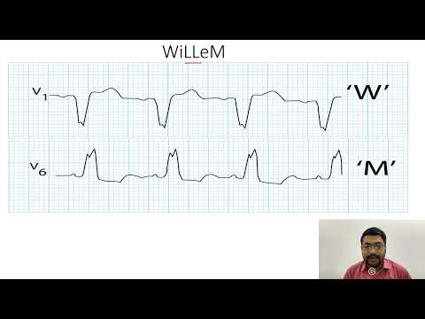 Mastering ECG:Lesson#14 Left Bundle Branch Block ECG discussion
