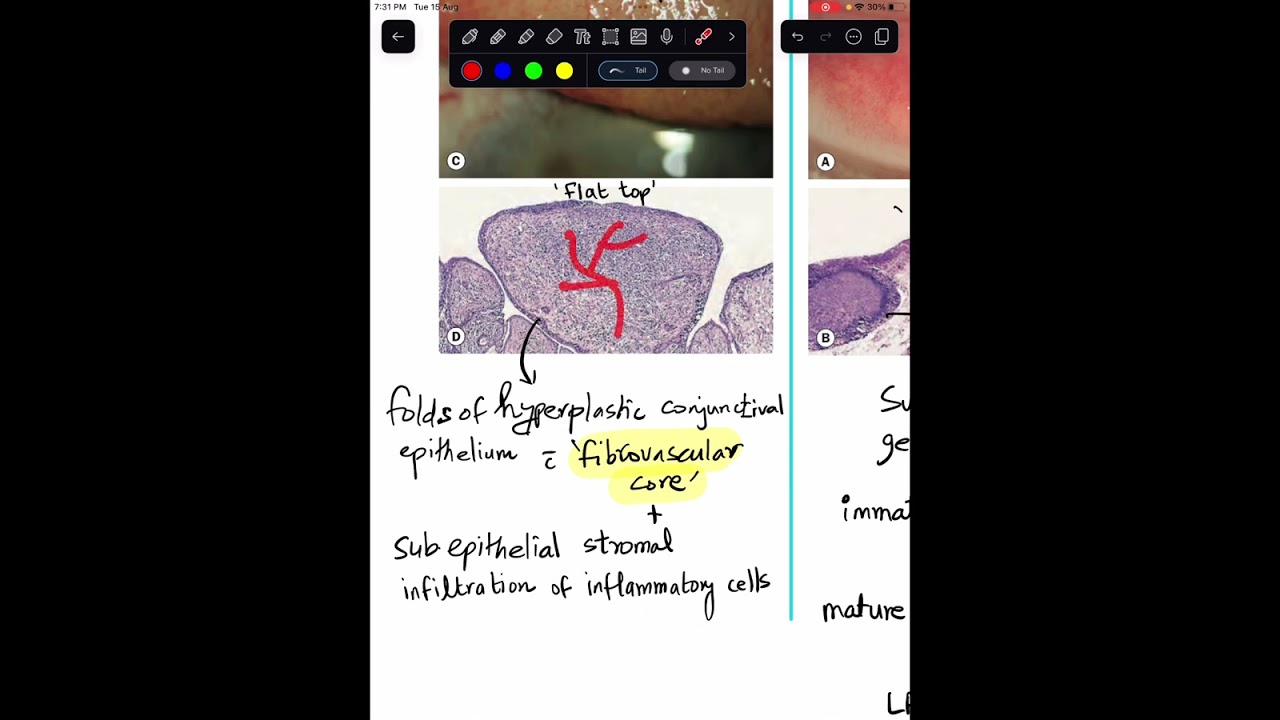 Papillae Vs. Follicles in Conjunctiva - Histopathology #Shorts
