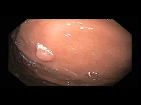 Fundic Gland Polyps