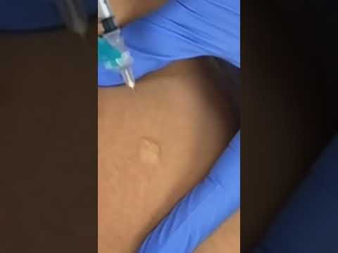 How to Give an Intradermal #Injection 💉 #TBTest #PPD #MedicalAssistant