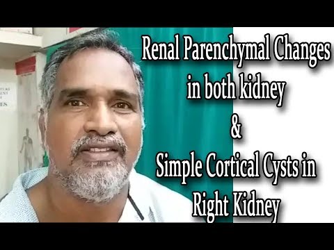 Renal Parenchymal Changes In Both kidney & Simple Cortical Cysts In Right Kidney @Nadipathy