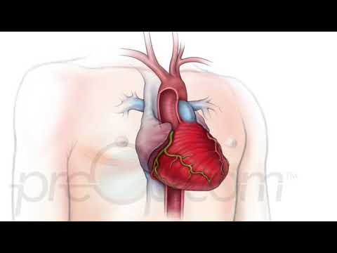 Diagnostic Cardiac Catheterization - PreOp® Patient Engagement and Patient Education