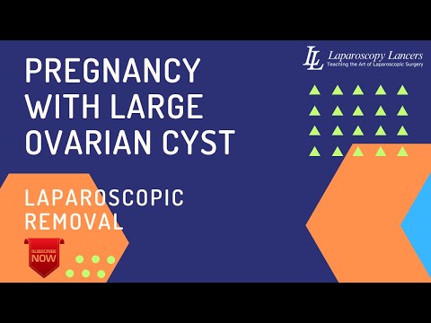 11 weeks Pregnancy with Ovarian - Torsion since 6 hours