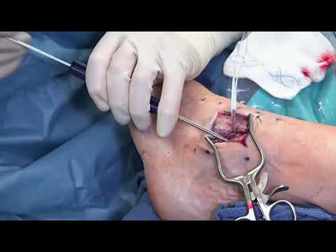 Anterior Talofibular Ligament Repair With Suture Tape Augmentation
