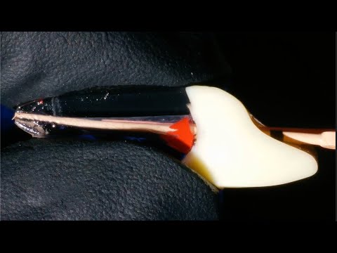 Root Canal Obturation - Lateral condensation technique