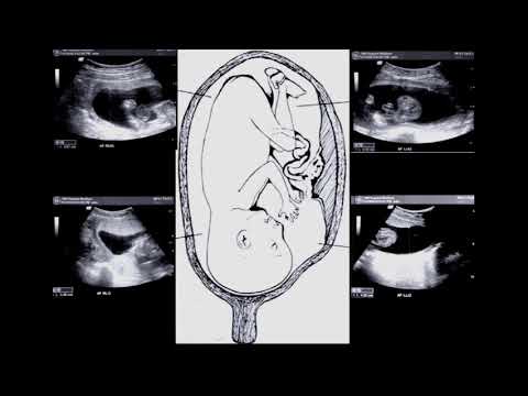 Sonography - Fetal Genitourinary System