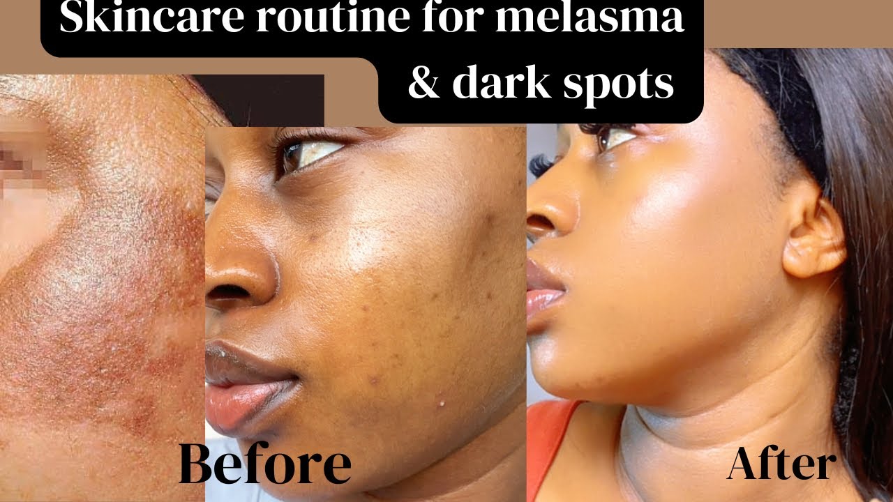 How I cleared my Melasma & Hyperpigmentation
