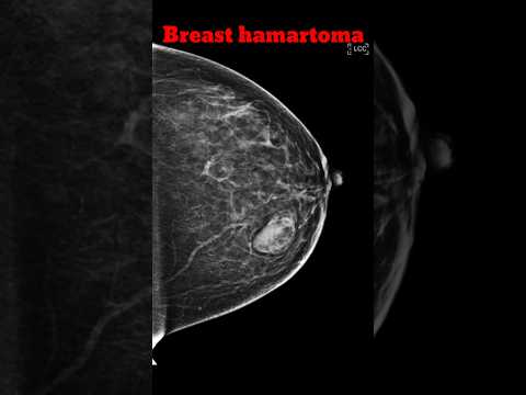 Breast Hamartoma | Mammography #shorts #breastimaging #mammography #mammogram #shortstrending