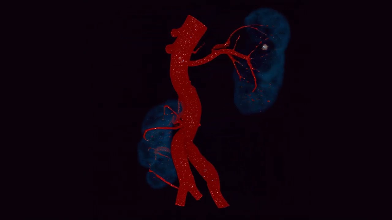 Enhanced Pelvic Kidney Video