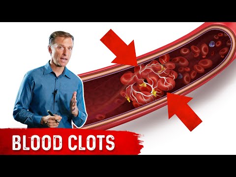 How to Know if You Have a Blood Clot