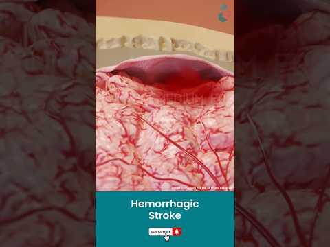 Brain Bleed (Hemorrhagic Stroke) ↪ 3D Medical Animation #Shorts #Brain #HemorrhagicStroke
