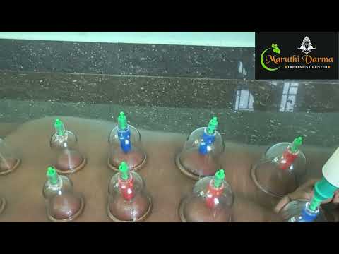 CUPPING THERAPY AT MARUTHI VARMA TREATMENT CENTER AT VALASARAVAKKAM, CHENNAI #ytshorts #tamil