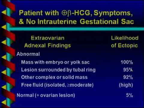 Ectopic Pregnancy
