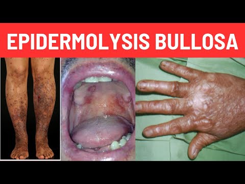 What is Epidermolysis Bullosa? Causes, Symptoms