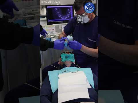 LASER Root Canal! #laser #dentistry #rootcanal #endodontic #endodontics