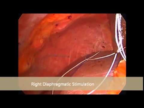 Diaphragmatic Pacer in an ALS Patient