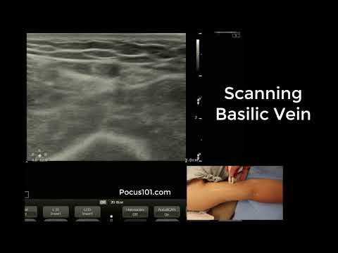 Scanning the Basilic Vein with Ultrasound